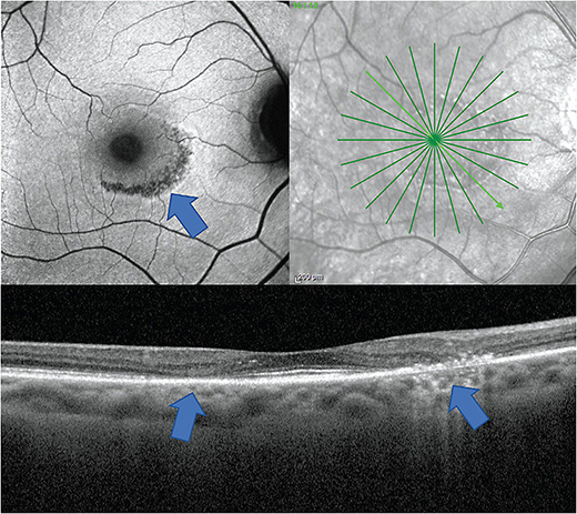 Serving Retina Patients: Have Their Backs | Optometric Management