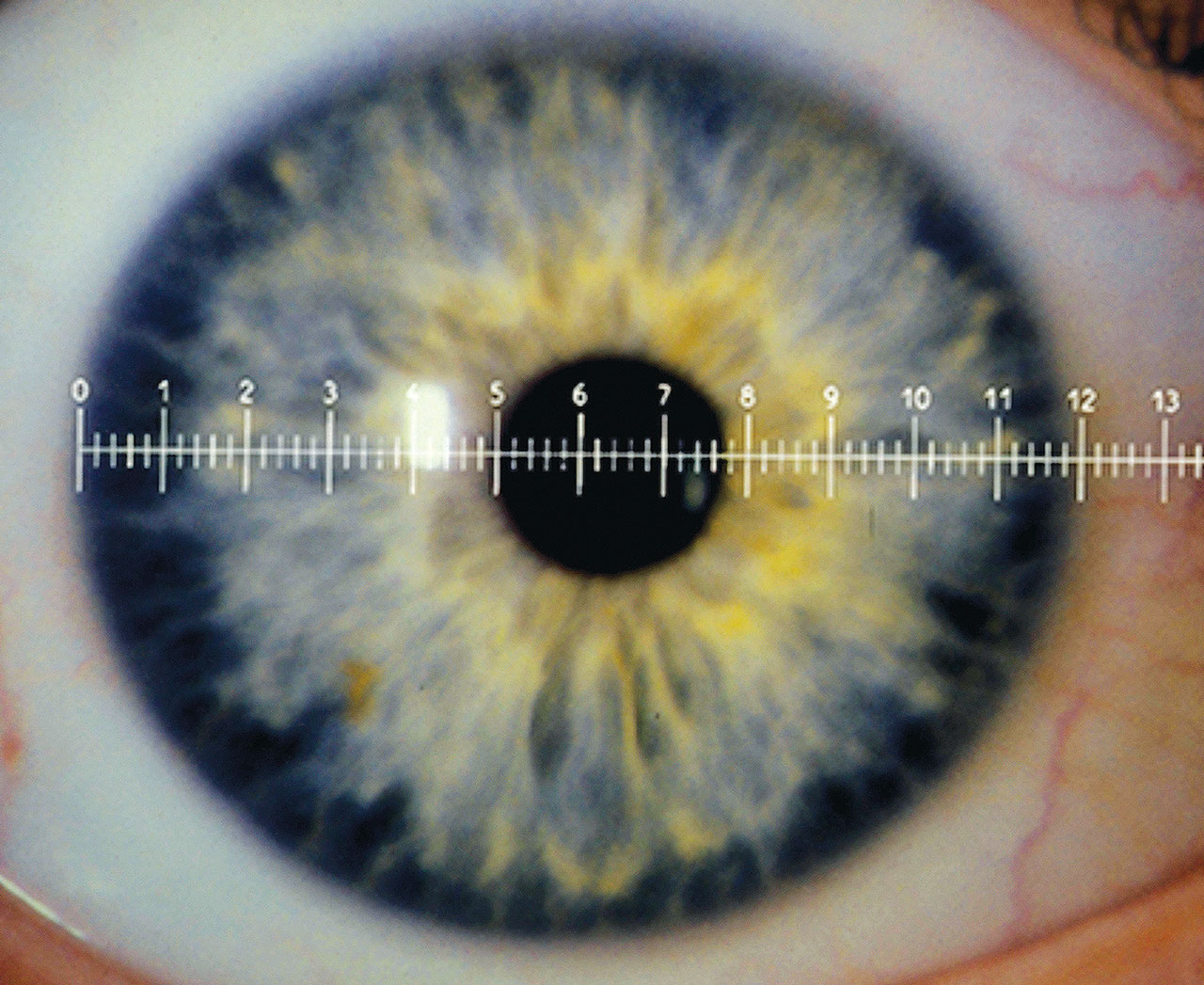 CONTACT LENSES: Talking soft torics | Optometric Management