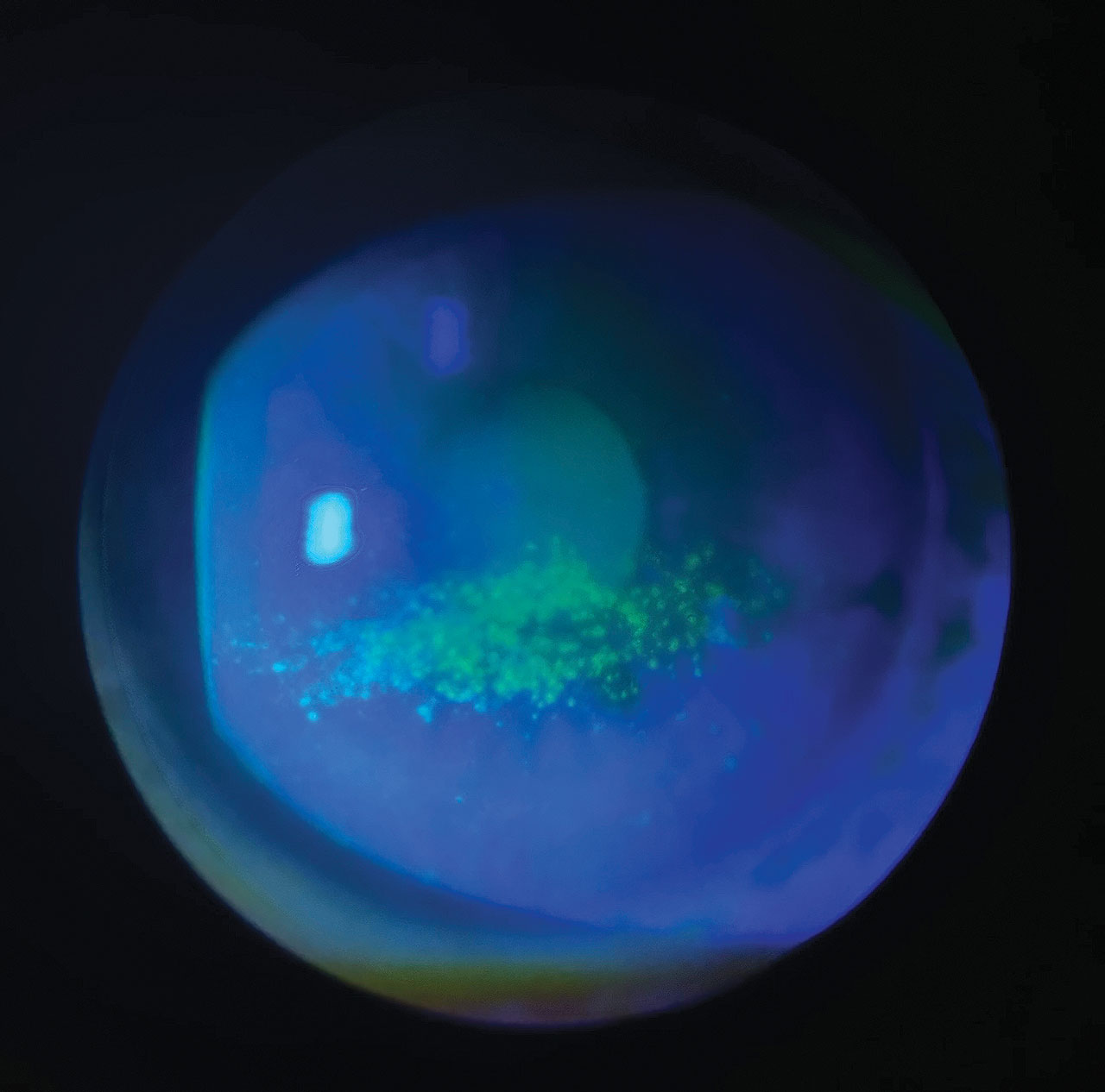 Dry Eye: Supporting Patients... | Optometric Management
