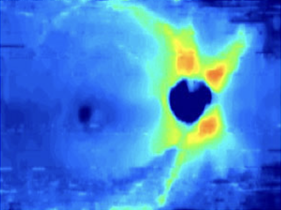 Myopia: Differentiating Optic Nerve Changes | Optometric Management