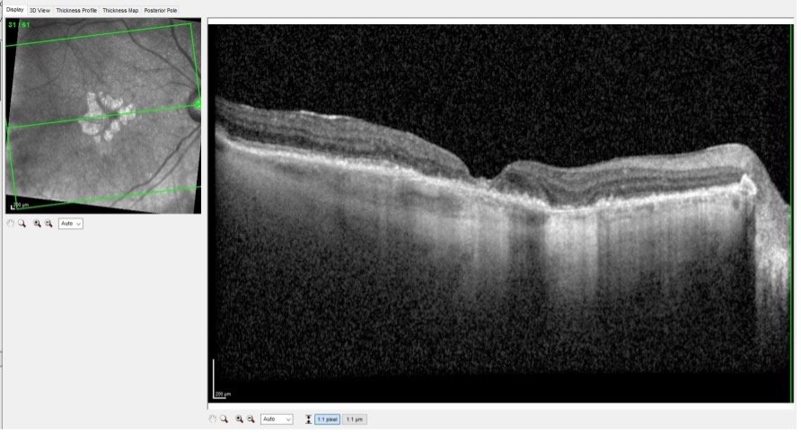 A Different Perspective on an Age-Old Disease | Optometric Management