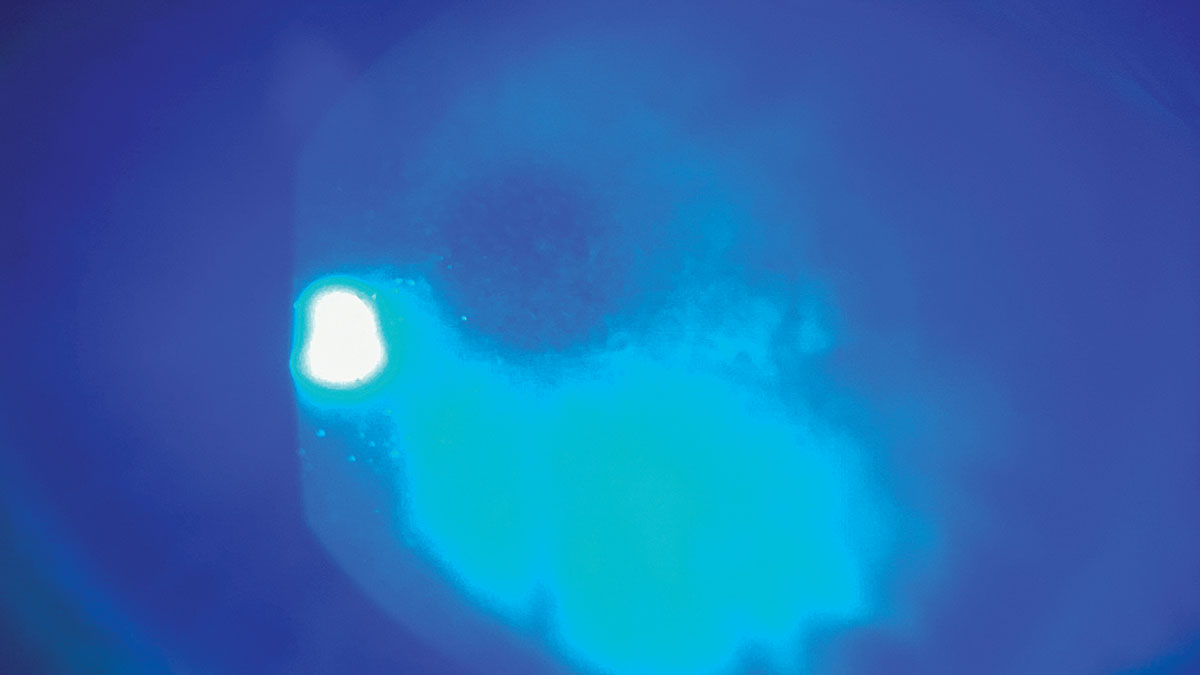 Dry Eye: Optimizing the Ocular Surface... | Optometric Management