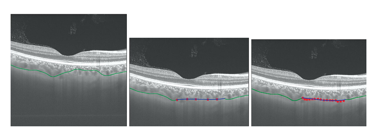 CLINICAL: Myopia: Choroidal response and myopia control | Optometric ...