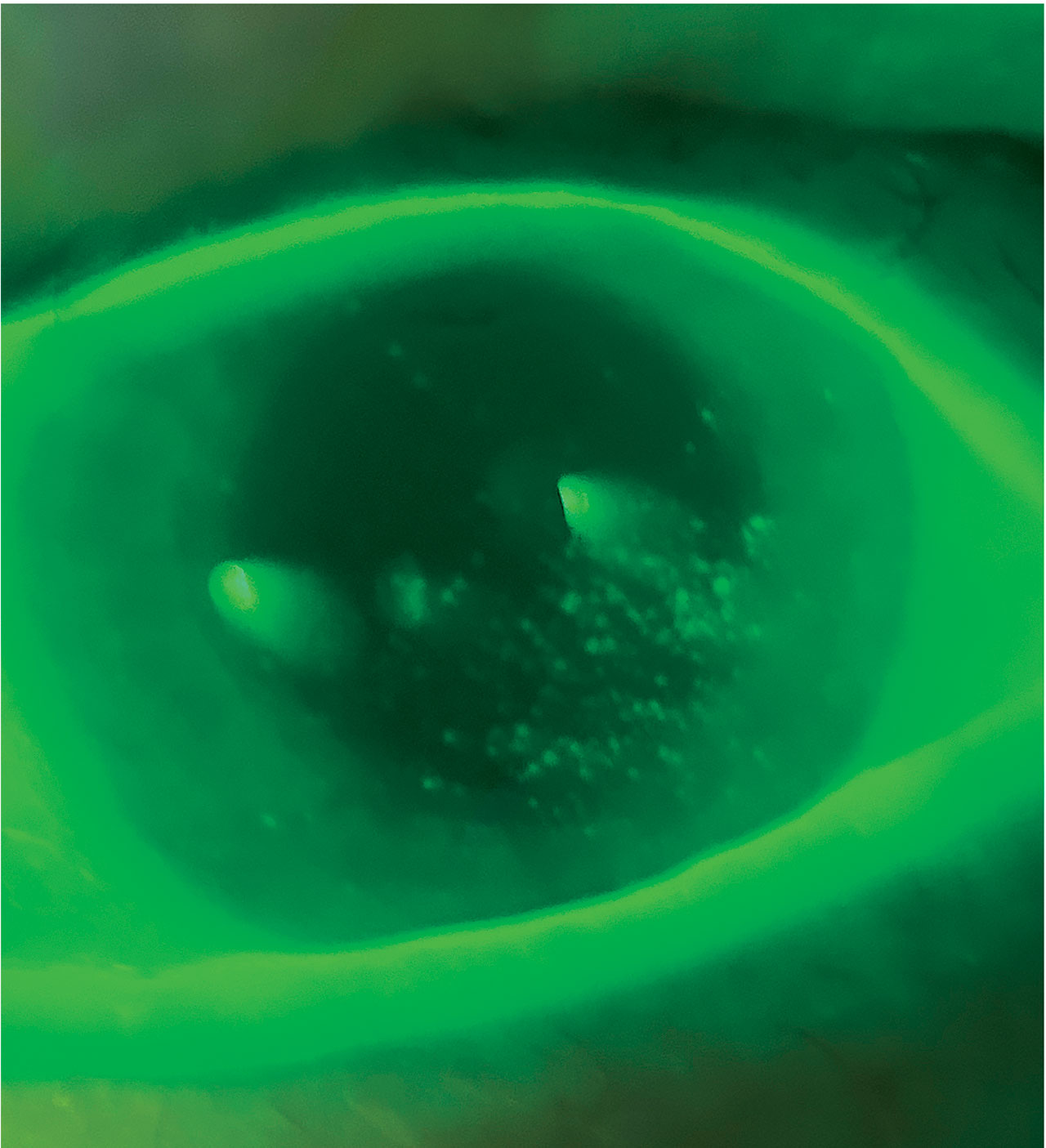 DRY EYE: Bolstering the tear film | Optometric Management