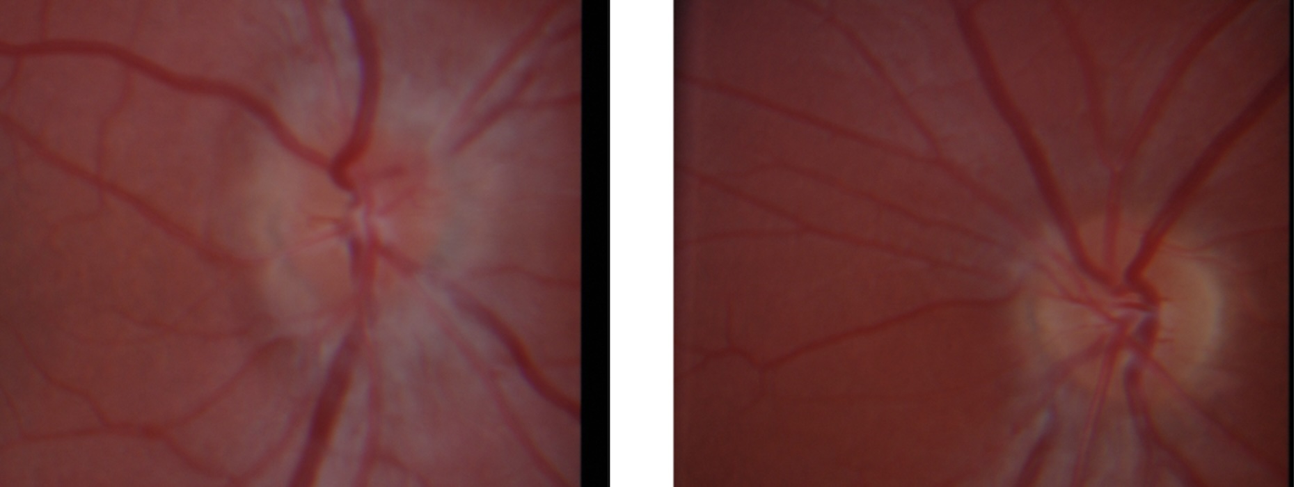 Key indicators of diseases | Optometric Management