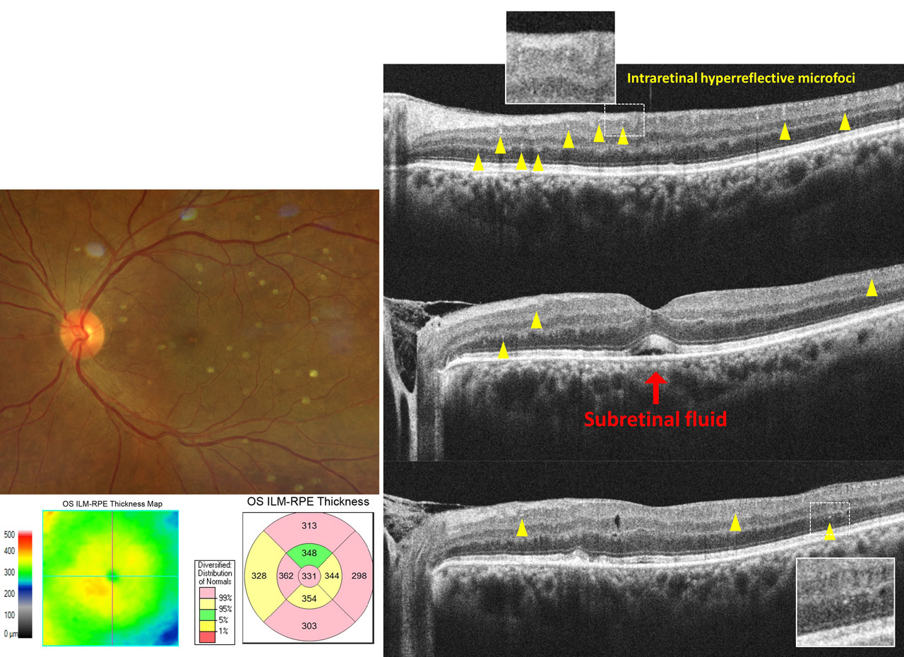 Combatting inflammation in diabetic retinopathy | Optometric Management