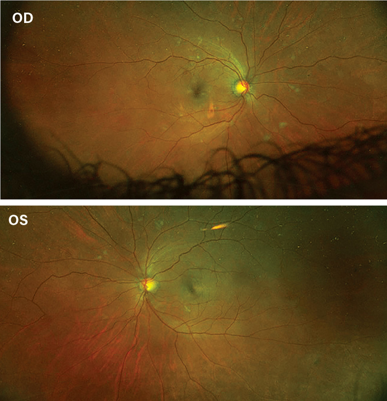 Case Study: Electroretinography in Diabetic Retinopathy | Optometric ...