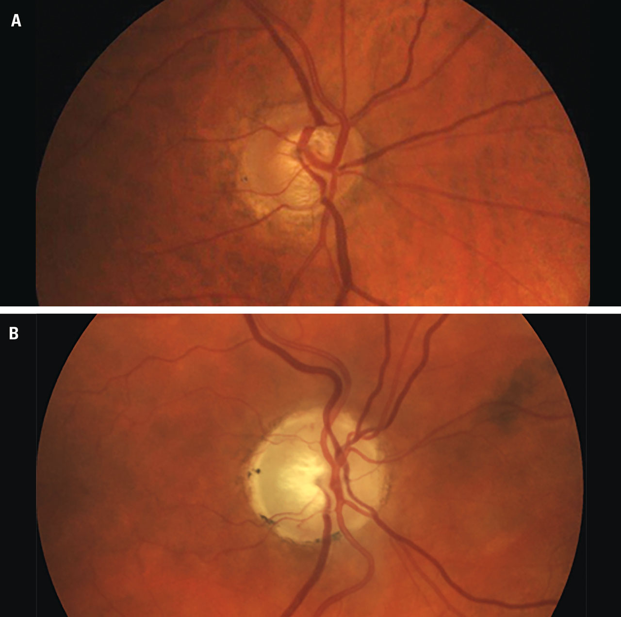 Glaucoma Optic Nerve Damage