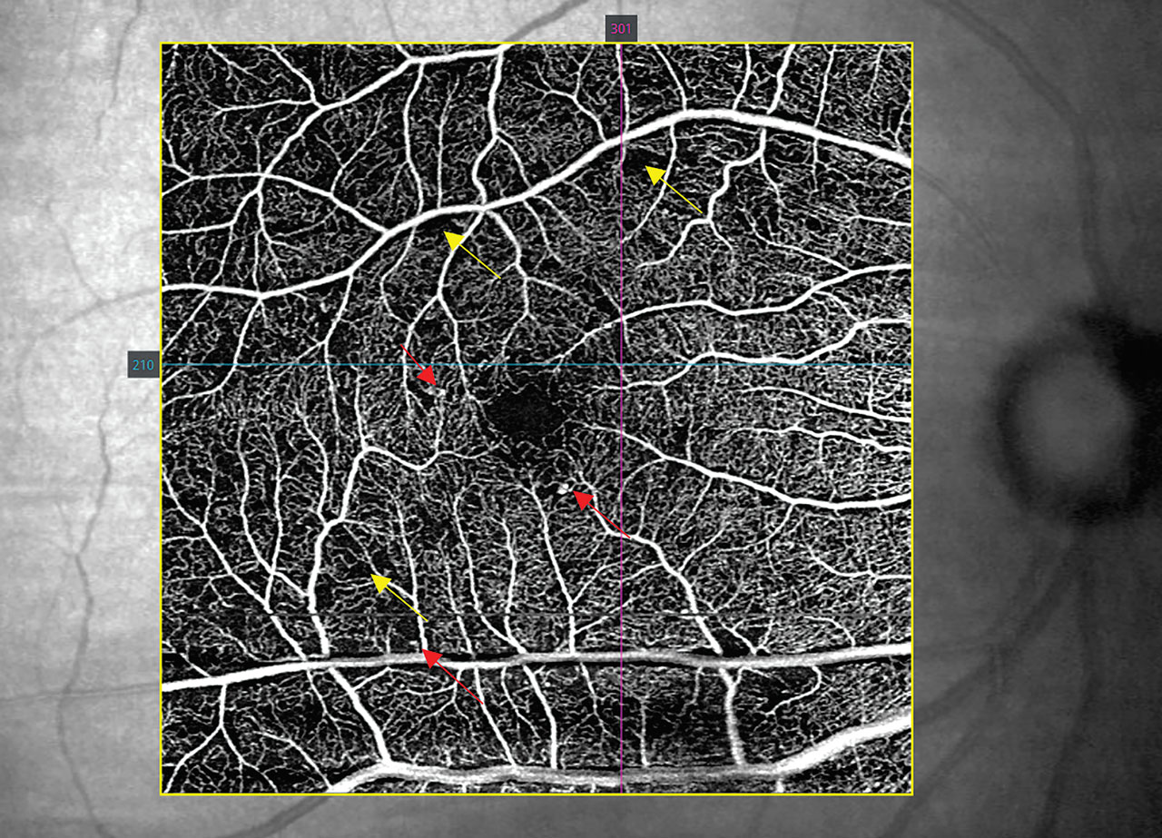 Recognizing the early signs of diabetic eye disease | Optometric Management